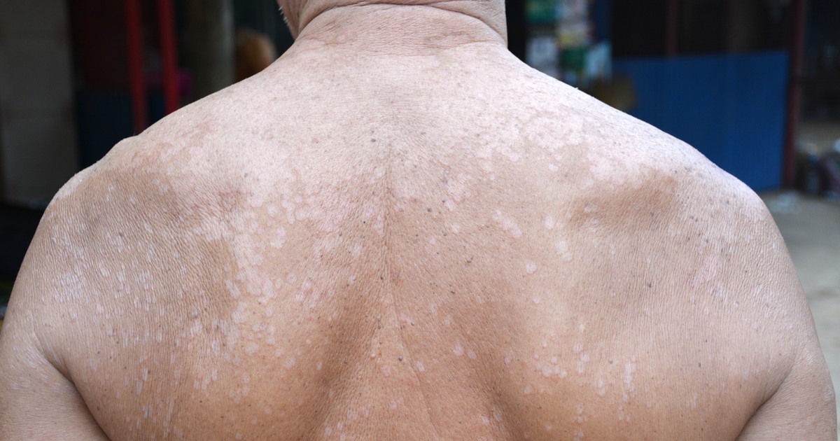 Łupież pstry - skąd się bierze? Co pomaga na łupież pstry?