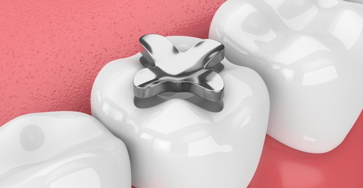 Plomby amalgamatowe - co kryje się w naszych zębach?