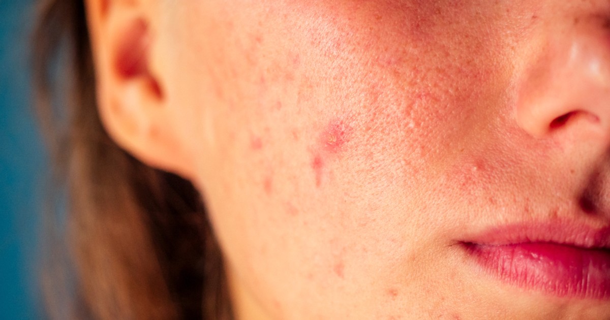 Aknemycin Plus - skład, działanie, wskazania, dawkowanie, przeciwwskazania