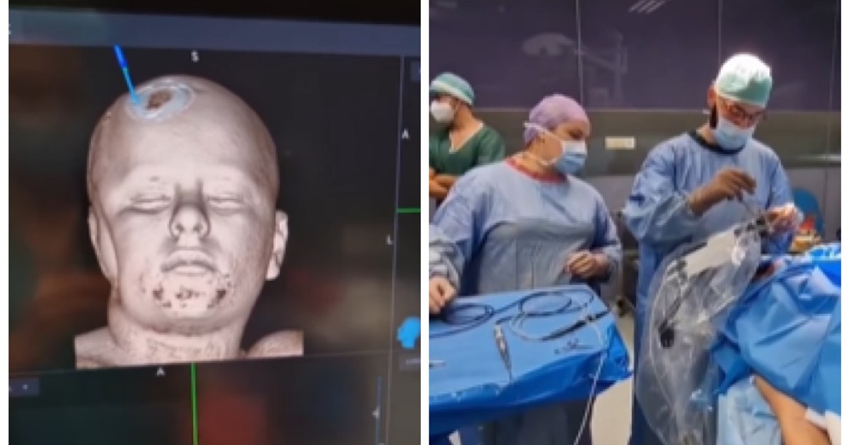 Polscy lekarze usunęli guza mózgu bez otwierania czaszki - Wiadomości