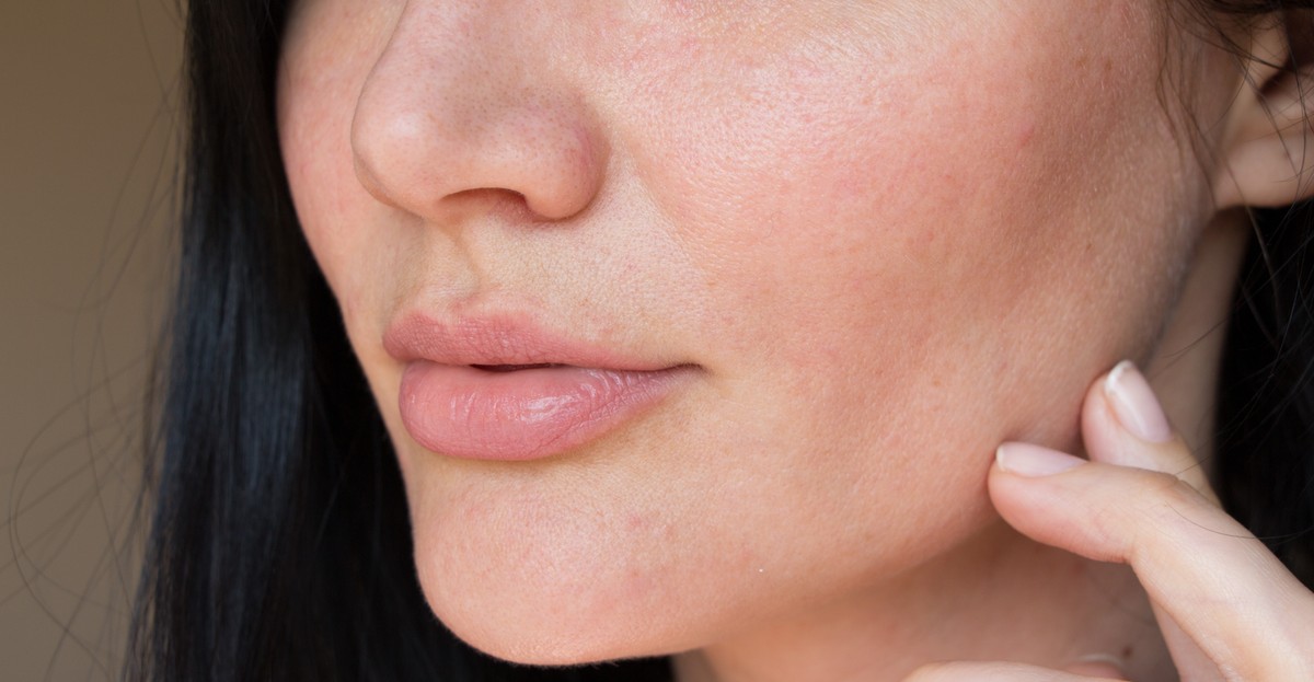 Sebum - co to jest? Czym charakteryzuje się nadmiar sebum?