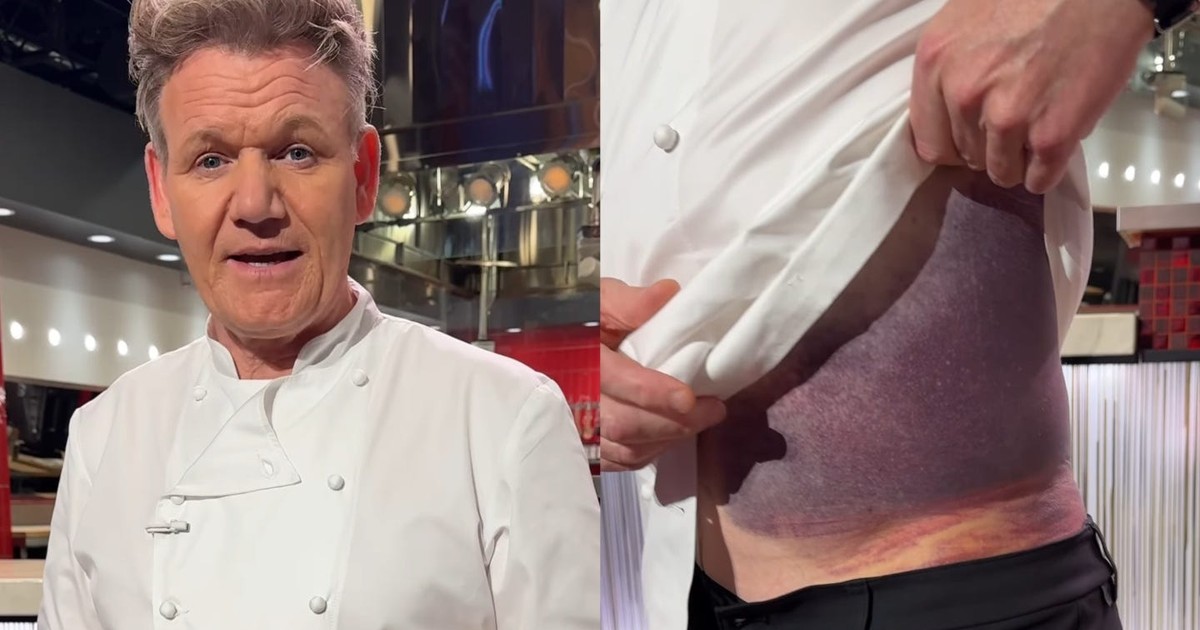 Gordon Ramsay shows off a scary bruise on his torso after getting in a ...