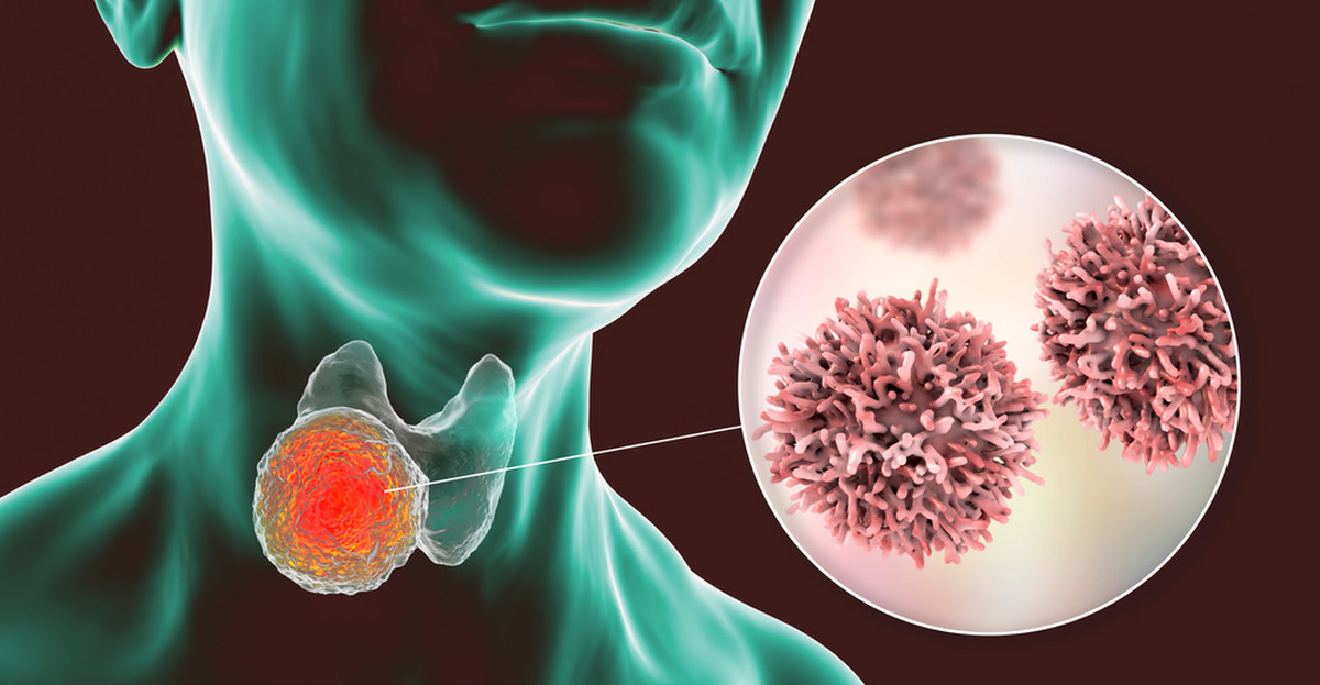 Siedem łatwych do przeoczenia objawów raka tarczycy