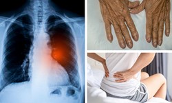 Nietypowy objaw raka płuc. Pojawia się na palcach i paznokciach. To tzw ...