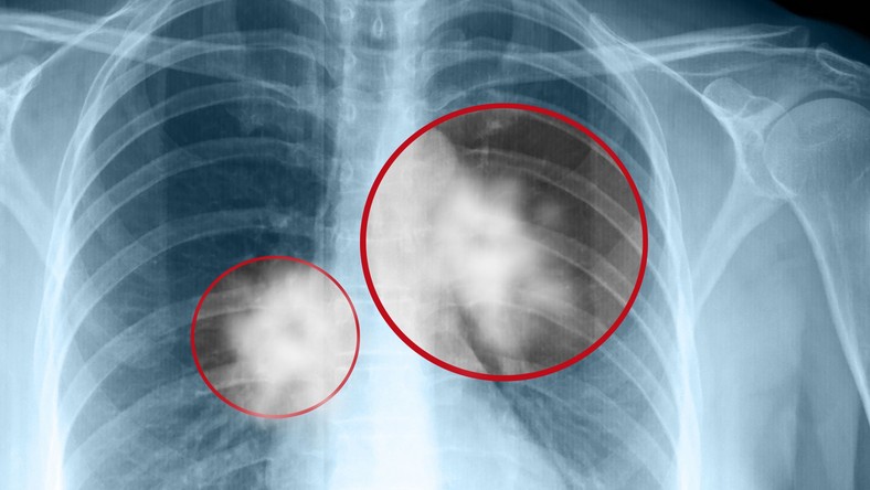 Eksperci: osoby niepalące coraz częściej chorują na raka płuca ...