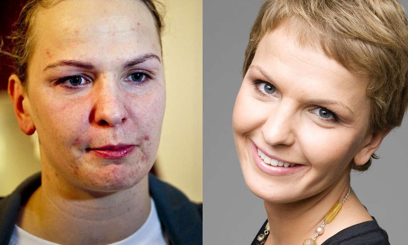Twarz Otylii Jędrzejczak. Pryszcze Otylii Jędrzejczak. Brzydka cera ... Twarz Otylii Jędrzejczak. Pryszcze Otylii Jędrzejczak. Brzydka cera ...