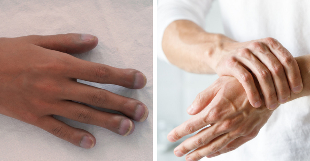 Nietypowy objaw raka płuc. Pojawia się na palcach i paznokciach. To tzw ...