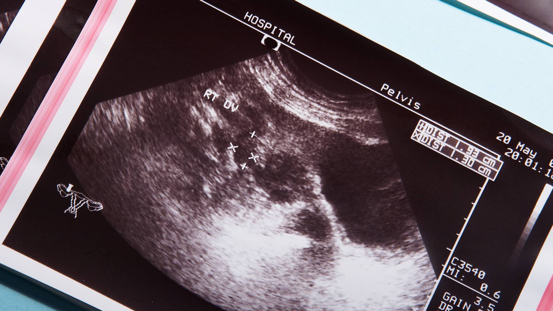 Potworniak - co to za choroba? Najdziwniejszt nowotwór | Ofeminin