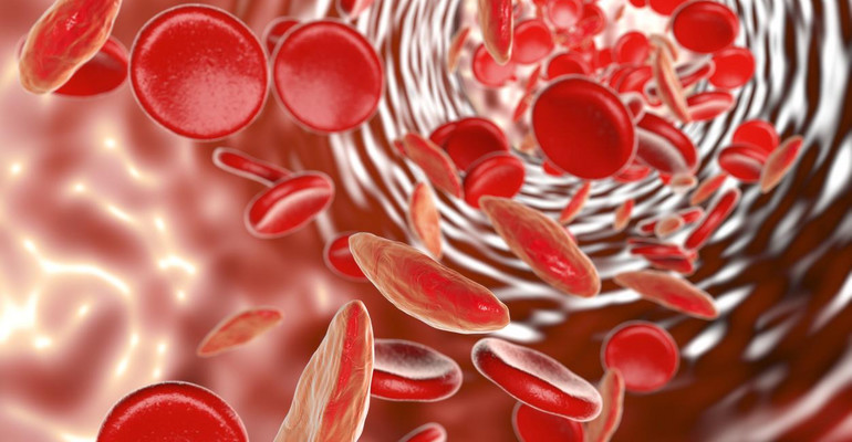 Sferocytoza wrodzona - przyczyny, objawy, leczenie