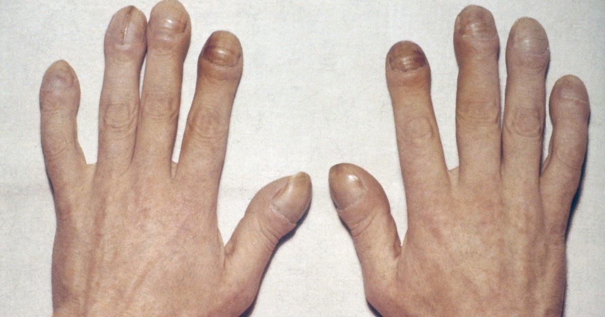 Twoje palce tak wyglądają? To objaw poważnej choroby