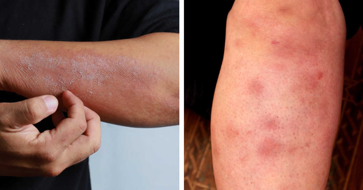 Tak jelita dają znać, że wysiadają. Objawy na skórze pojawiają się na ...