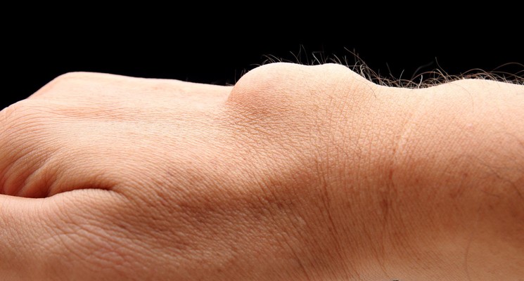 Torbiel galaretowata - przyczyny, objawy i leczenie