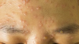 Ospa u dzieci - objawy, leczenie i przebieg choroby. Ile trwa ospa?