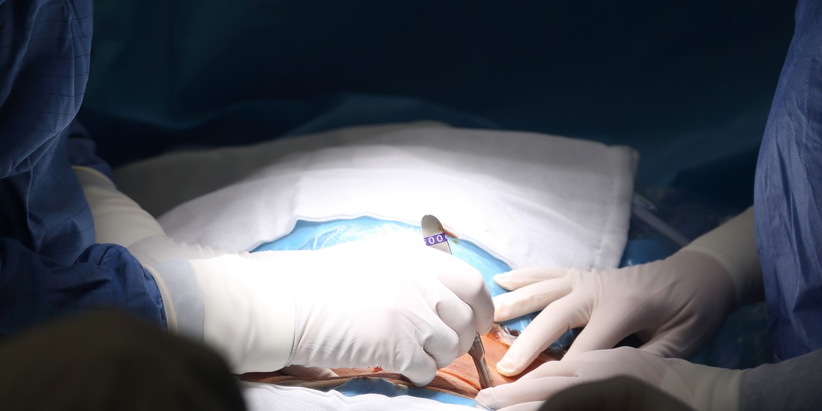 Laparotomia: czym jest, jak przebiega, laparotomia zwiadowcza ...