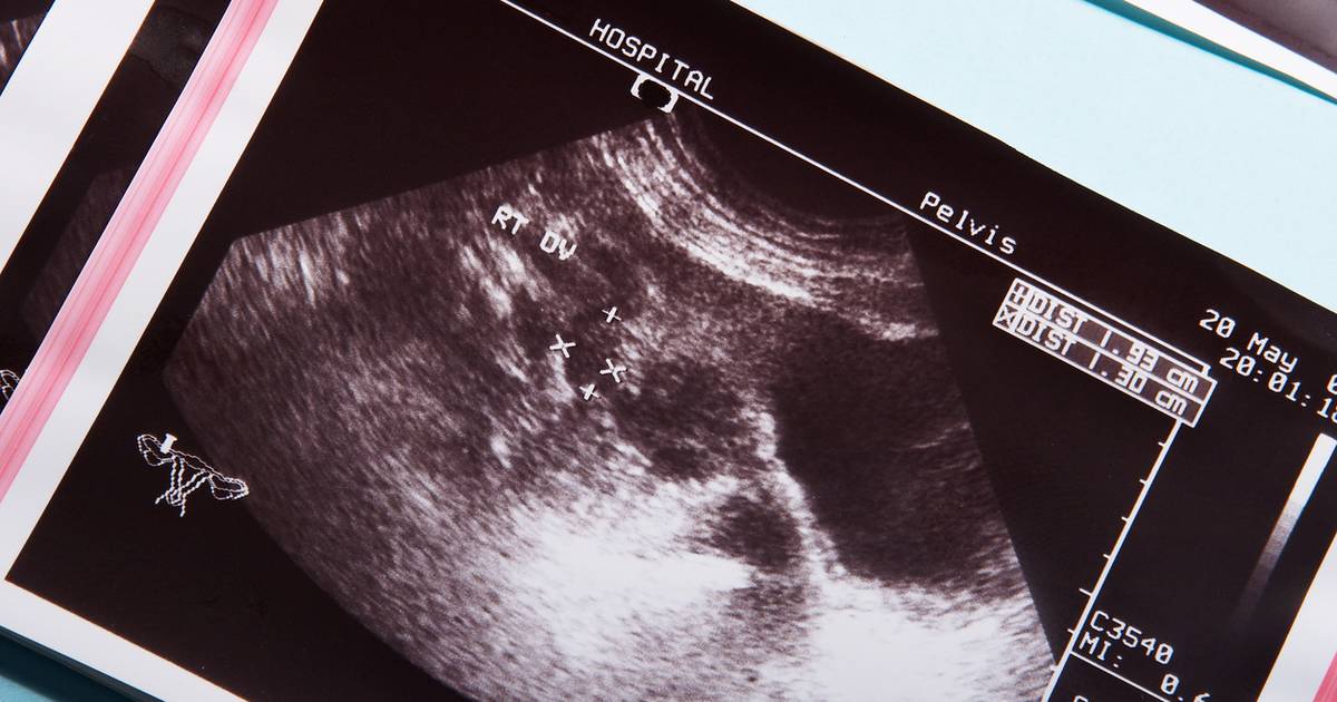 Potworniak - co to za choroba? Najdziwniejszt nowotwór | Ofeminin