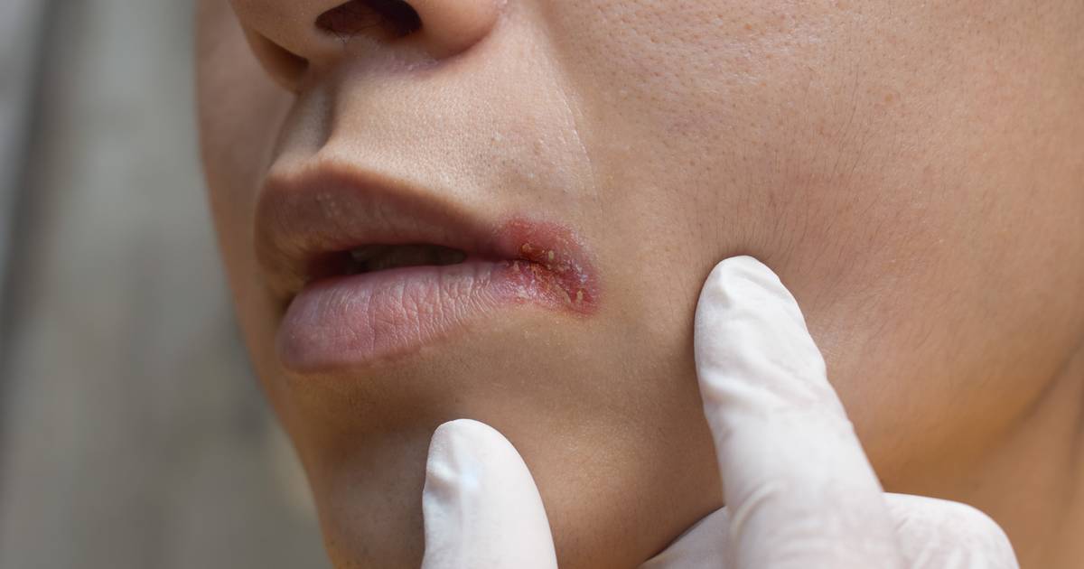 Maść na zajady z witaminą B działa cuda. Szybko pomaga i kosztuje osiem ...