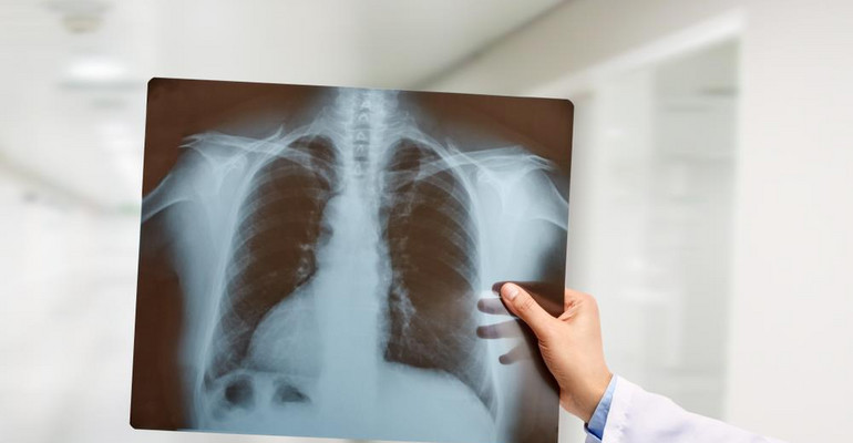 RTG płuc - jak interpretować wyniki?