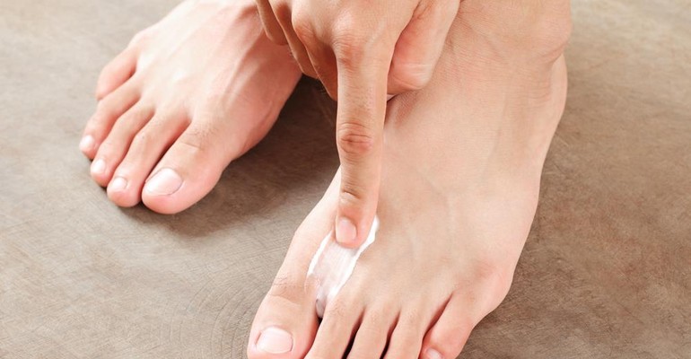 Grzybica stóp – jak można się zarazić? Objawy i rodzaje grzybicy stóp