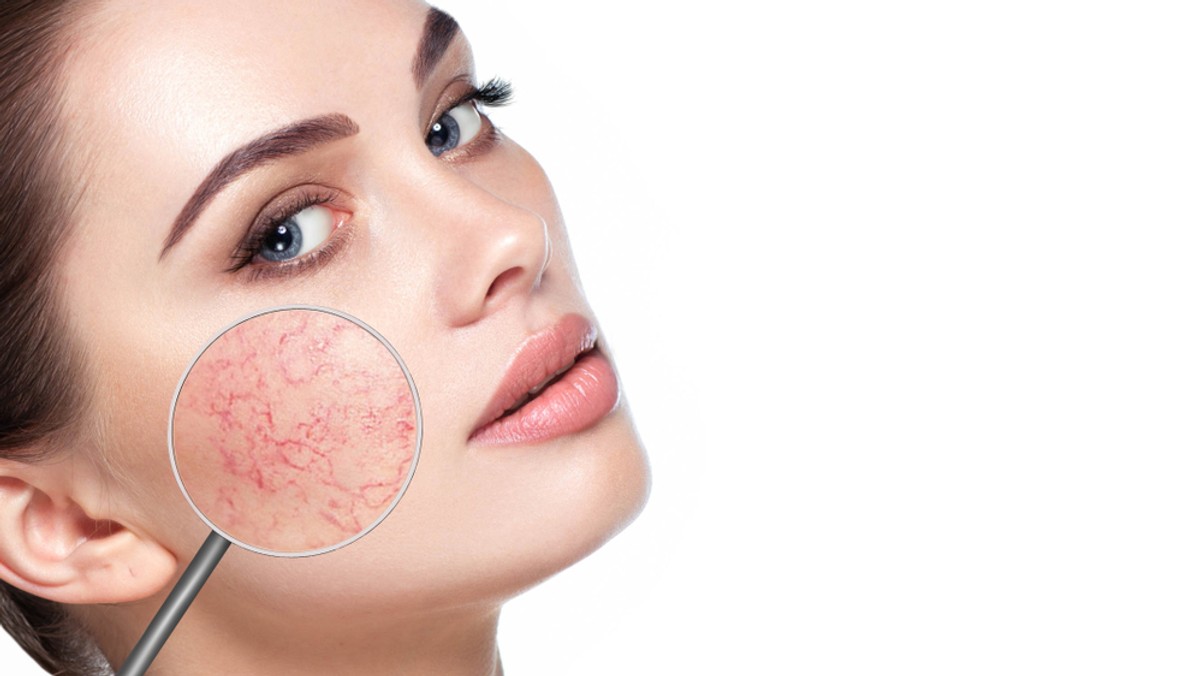 Cera naczynkowa. Jak przetrwać zimę? - Uroda