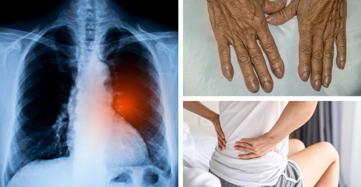 Objawy raka płuc, które widać na wiele miesięcy przed diagnozą