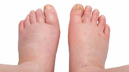 Lipodemia (obrzęk tłuszczowy) - opis, objawy, leczenie