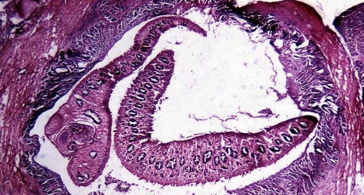 Motylica wątrobowa - przyczyny i objawy choroby