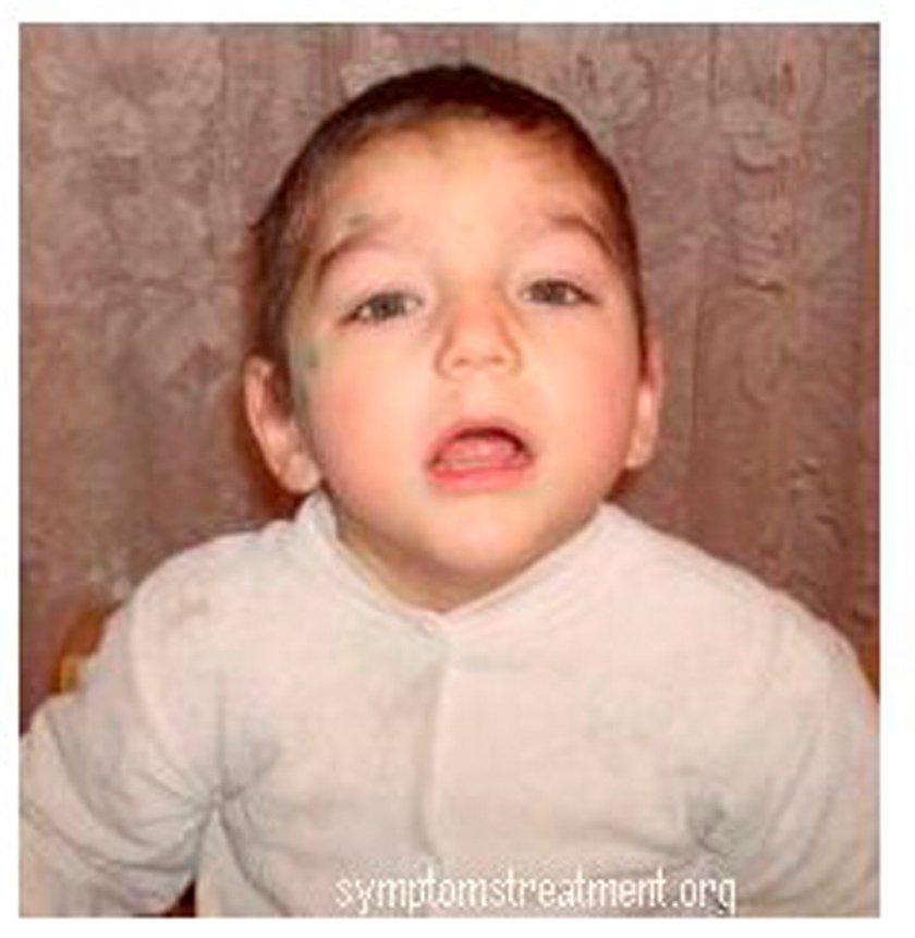 Zespół płodowy alkoholowy - FAS. Chore dzieci. Od wódki