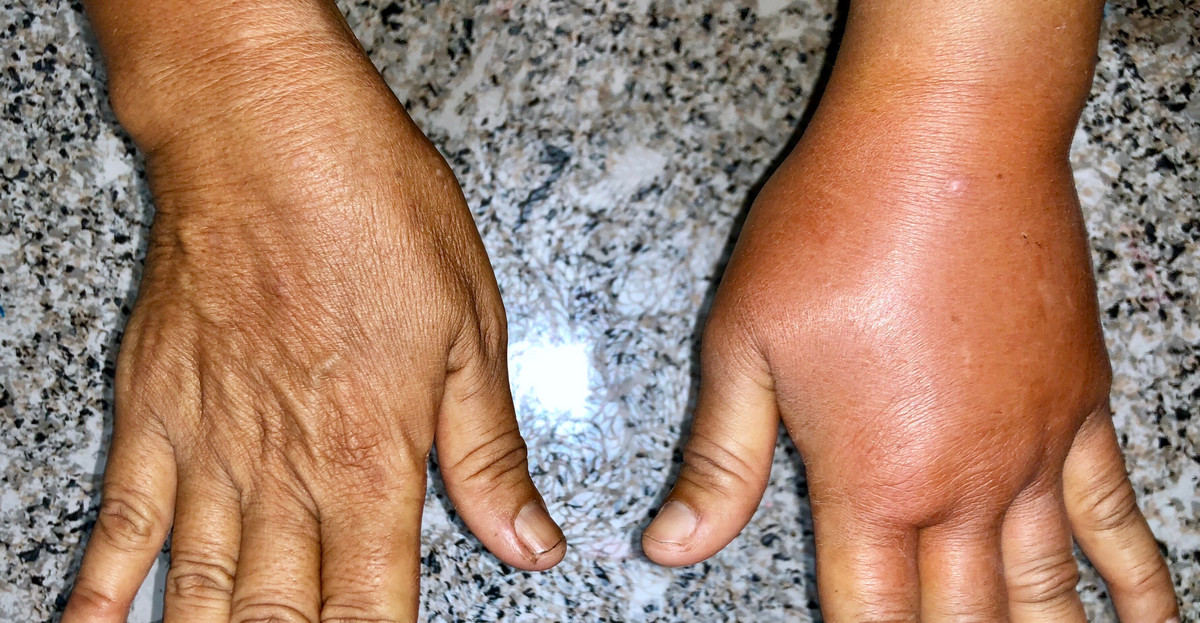 Obrzęk limfatyczny - rodzaje, przyczyny, objawy, diagnostyka, leczenie