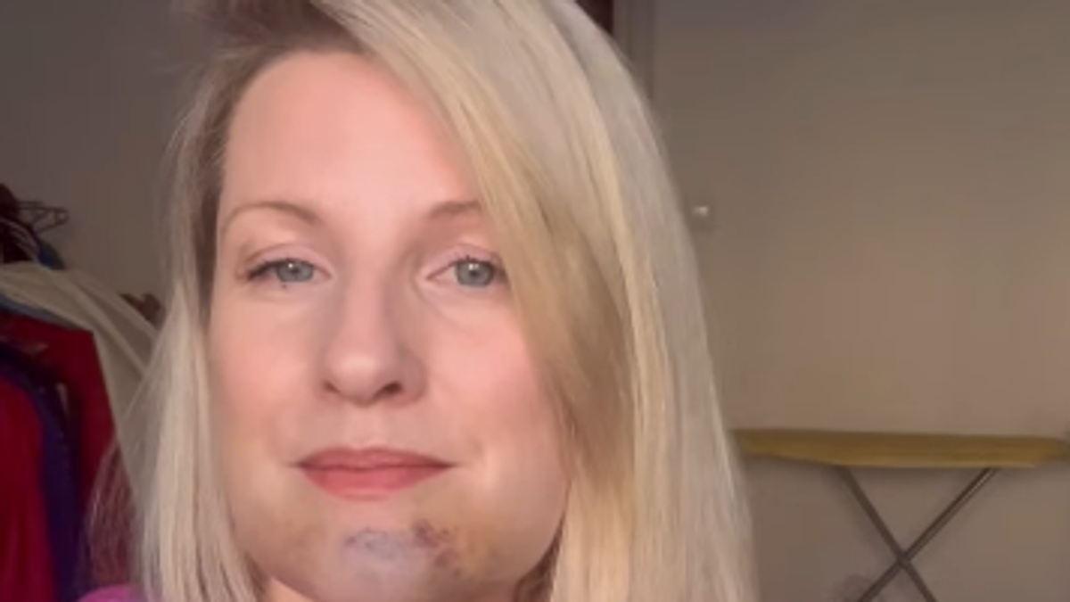 Pevačici lice svo u modricama i podlivima, evo šta joj se desilo:"Ovako izgledam treći dan nakon ...