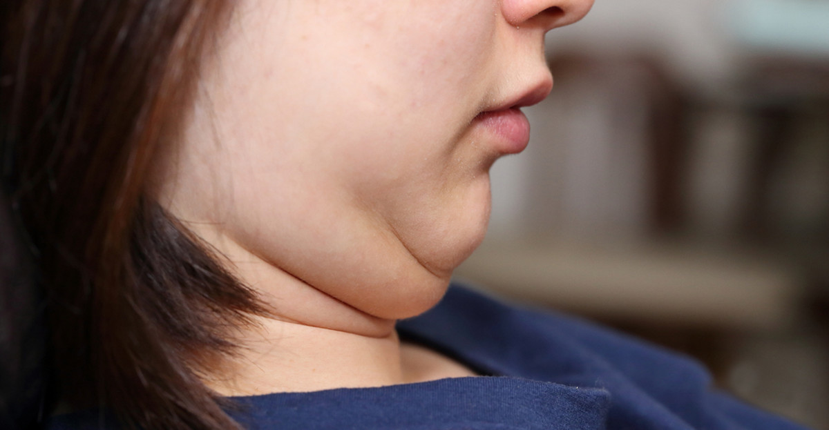 Nalana twarz może oznaczać problemy z tarczycą, nerkami, hormonami