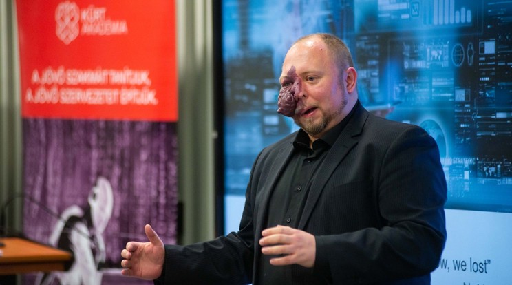 Szabados Levente védjegyévé vált az arcát eltorzító érdaganat - Blikk