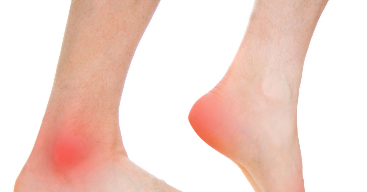 Jak opatrywać pęcherze i otarcia? Pierwsza pomoc - Dziennik.pl