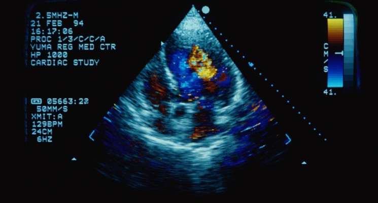 USG dopplerowskie - wskazania, przygotowanie do badania, przebieg