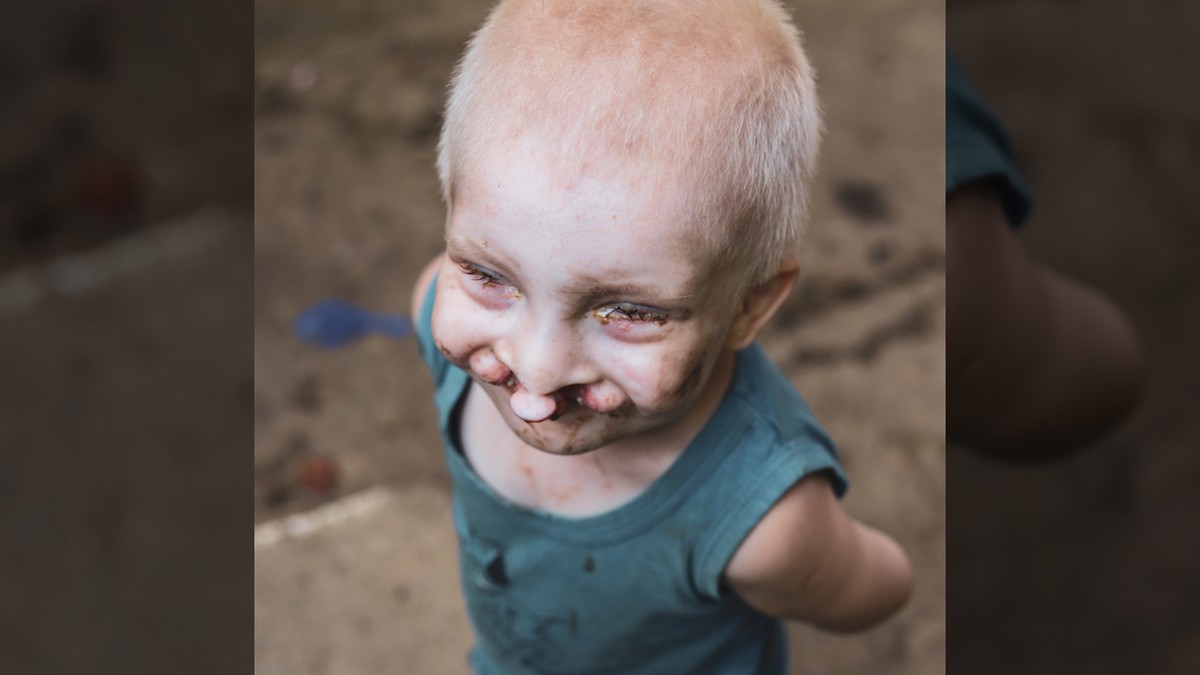 Mali Pavle koji ima rascep nepca i usne i nem je sada ide na operaciju ...