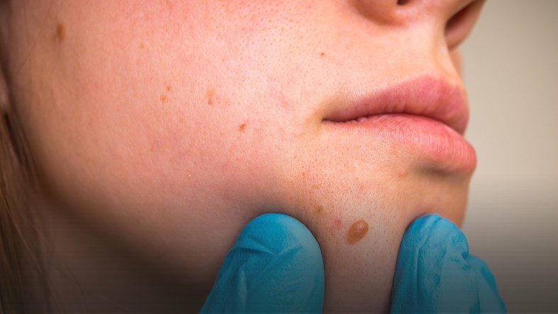 Mapa ludzkiej twarzy. Jakie zmiany skórne naprawdę powinny nas ...