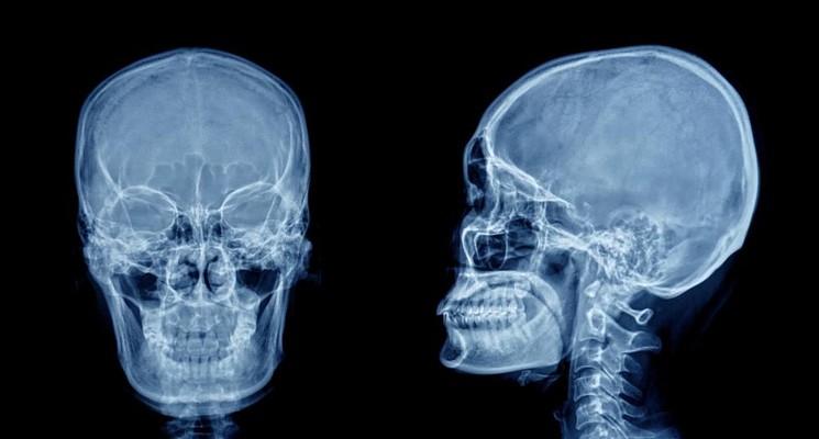 Guz mózgu (nowotwór mózgu) - objawy, rodzaje i rozpoznanie