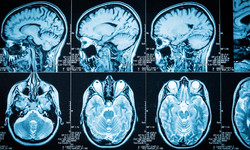 Glejak mózgu - objawy, leczenie, rokowania