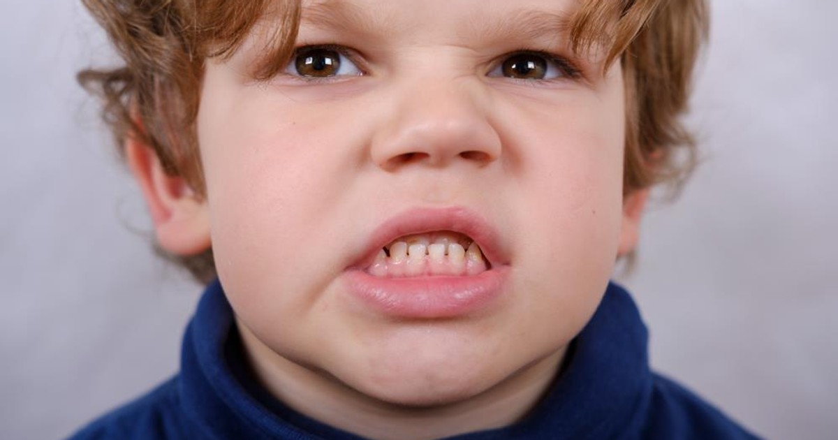 Progenia - przyczyny i charakterystyka wady zgryzu. Jak wygląda ...