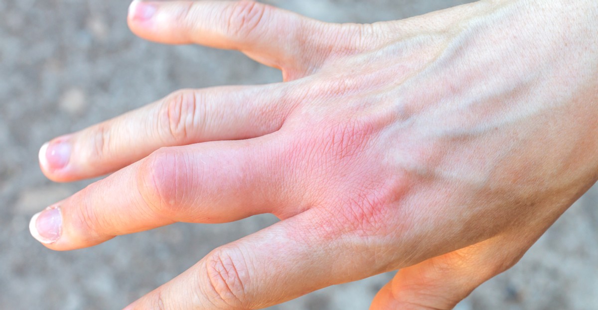 Czy wiesz, jak radzić sobie z ukąszeniami owadów? Sprawdź