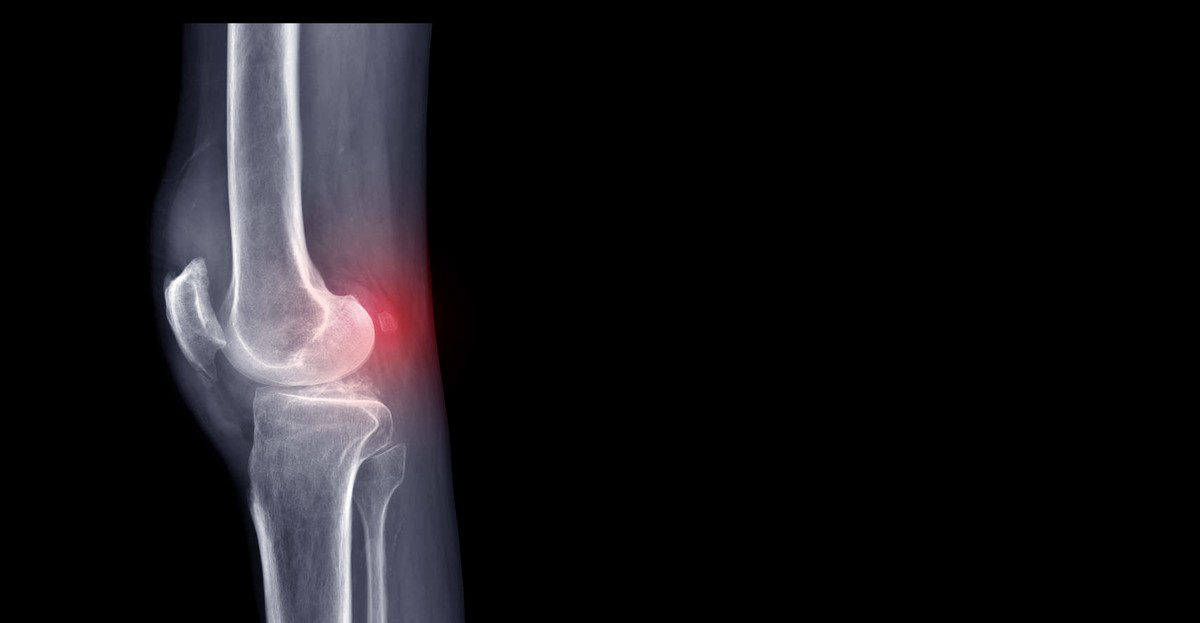 Fabella - przyczyny, anatomia, funkcje. Czy fabella powoduje ból?