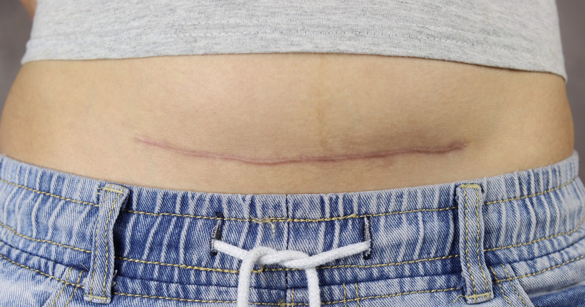 Jak sprawdzić, czy mam zrosty po CC? Lista objawów od położnej - Dziecko