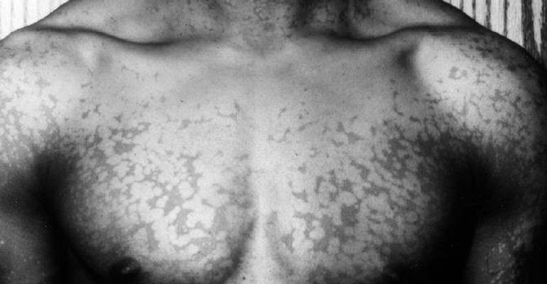 Łupież pstry - przyczyny, objawy, leczenie. Domowe sposoby na łupież pstry