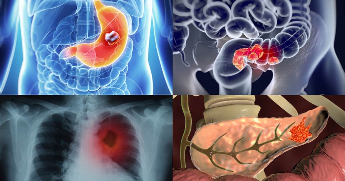 Najgorsze nowotwory, które rozwijają się po cichu. Diagnoza pojawia się ...