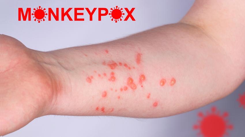 1979 előtt született és magyar? Ezért nem kell aggódnia a majomhimlő ...