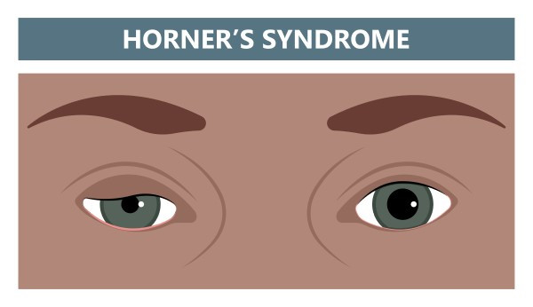 Nietypowy objaw raka płuca. Zmienia połowę twarzy, zwłaszcza oko