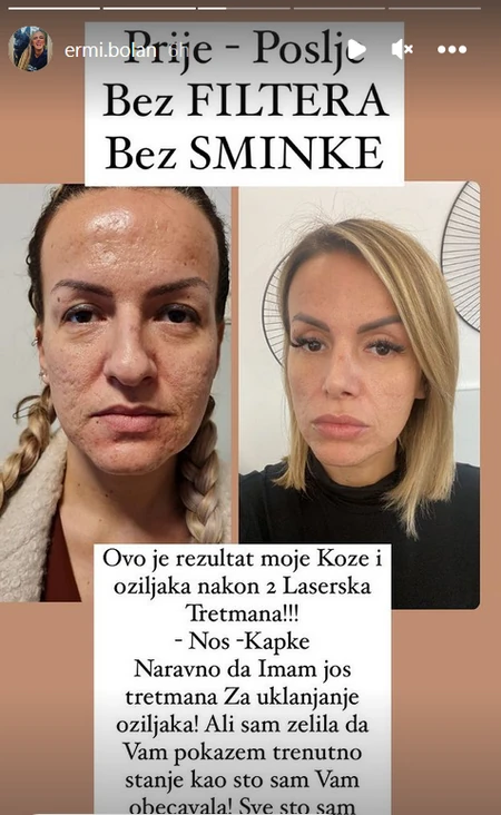 Ermina Pašović pokazala lice pre operacija - Blic