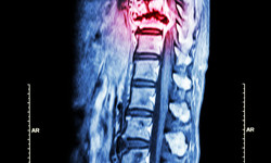 Potworniak - najdziwniejszy z nowotworów. Rodzaje i leczenie potworniaków