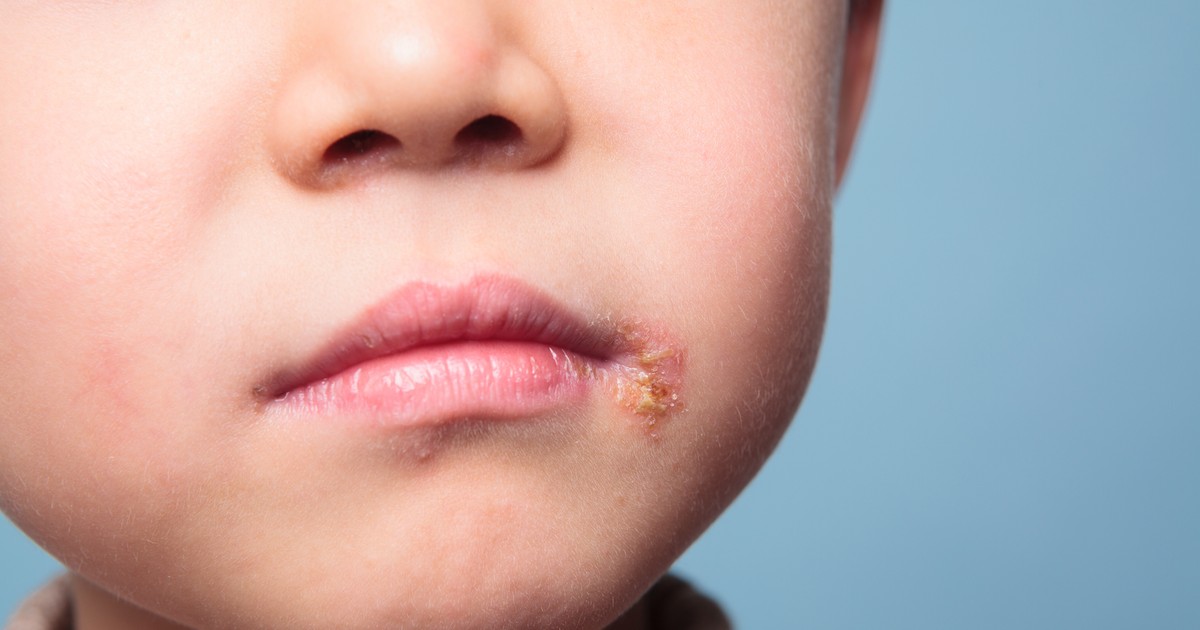 Wirus opryszczki u dzieci - przyczyny, objawy, leczenie i powikłania
