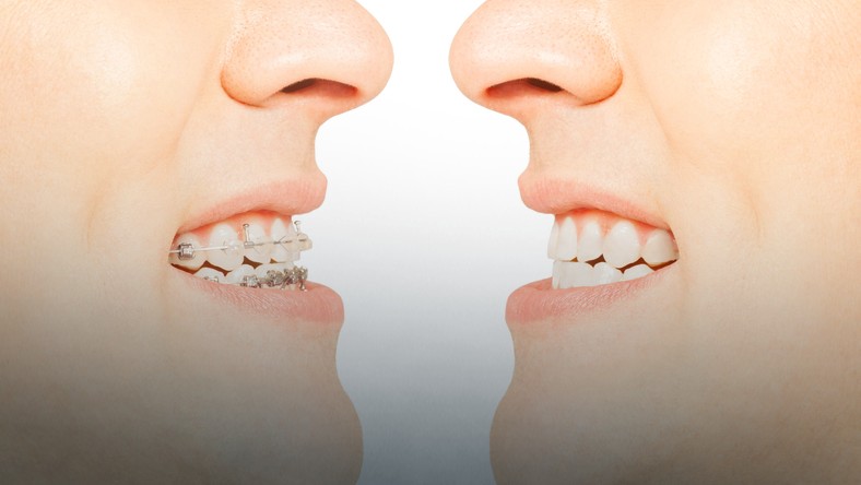 Progenia - objawy, operacja, progenia u dziecka - Zdrowie