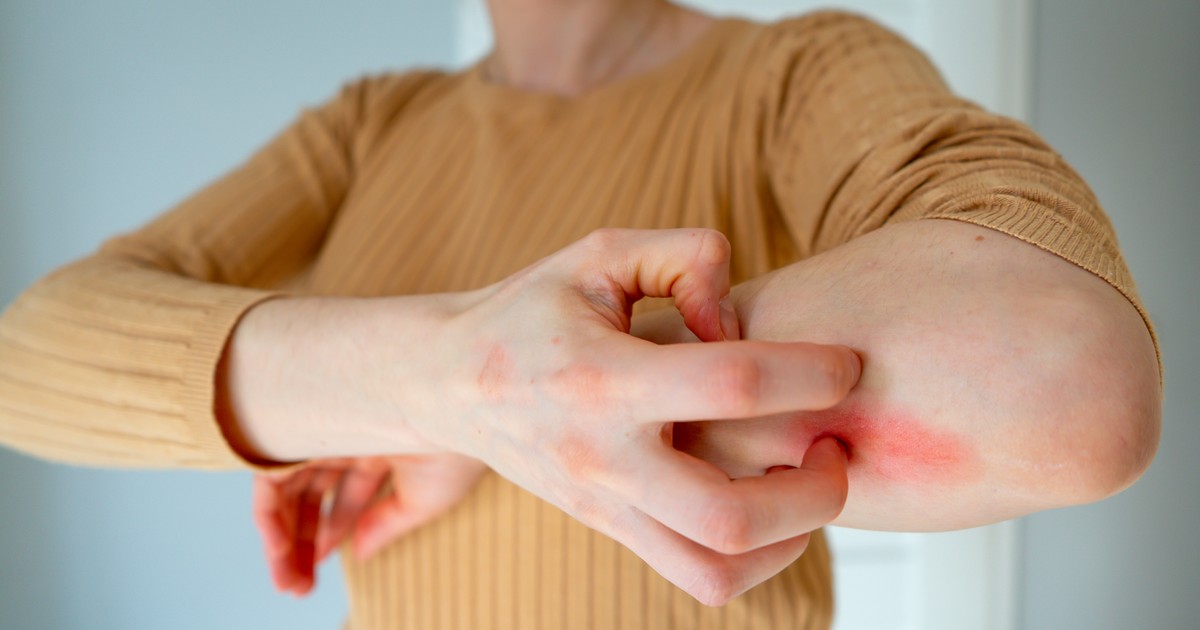 Wysypka skórna - rodzaje, przyczyny, objawy, uczulenie, wysypka jako ...